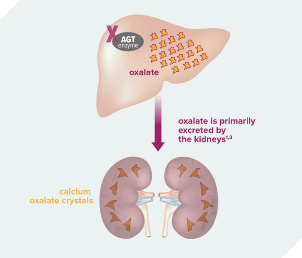 About Primary Hyperoxaluria Type 1 | OXLUMO® (lumasiran)